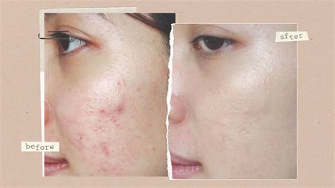 How To Hide Pimples With Makeup Without Concealer Makeupview Co