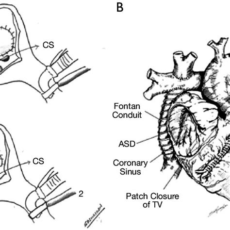 Carpentier Classification Of Ea Ea Ebsteins Anomaly Ra Right Carpentier Classification Of Ea Ea Ebsteins Anomaly Ra Right