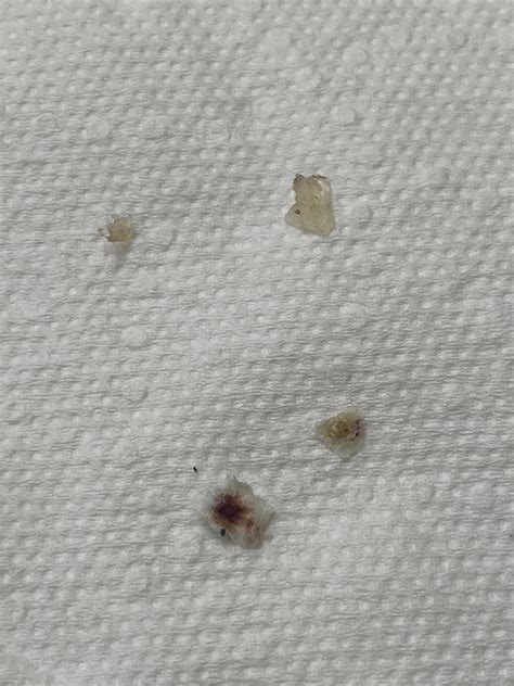 No Microscope Needed R Scabies