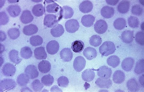 Free Picture Thick Film Micrograph Mixed Falciparum Malariae Parasitic Infection