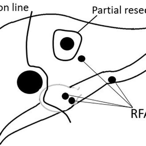 The Patient Underwent Extended Right Posterior Segmentectomy With Download Scientific Diagram