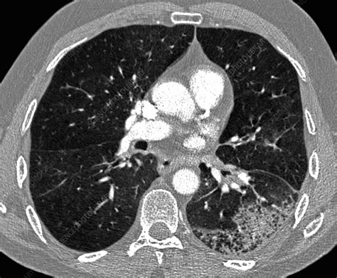 Segmental Pneumonia Lung Ct Scan Stock Image C038 4563 Science
