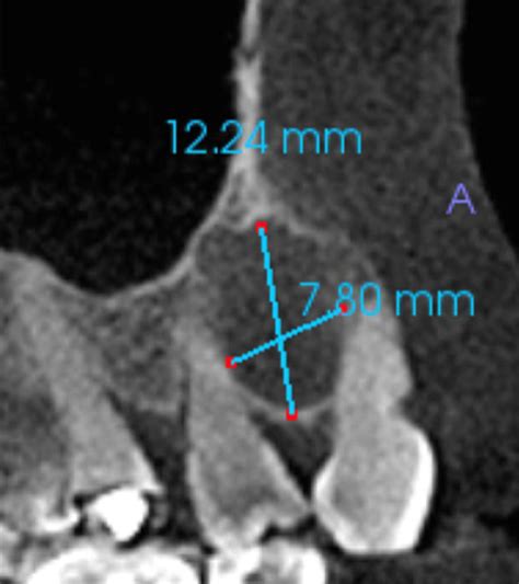 49 Year Old Woman With Maxillary Lesion Drbicuspid
