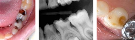 Assessing Risk Of Progression Prevention And Management Of Dental