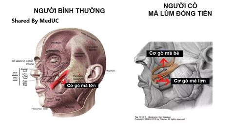 MÁ LÚm ĐỒng TiỀn DƯỚi GÓc NhÌn GiẢi PhẪu HỌc BÍ Ẩn NÉt DuyÊn TỪ CƠ MẶt