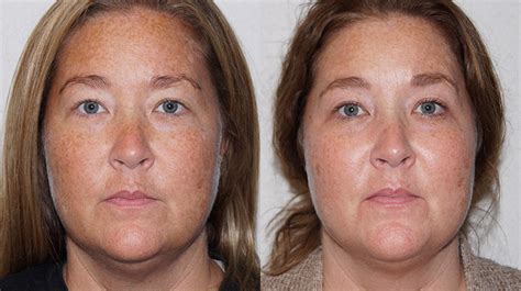 Chemical Peel Process Results Recovery And More Lovelyskin