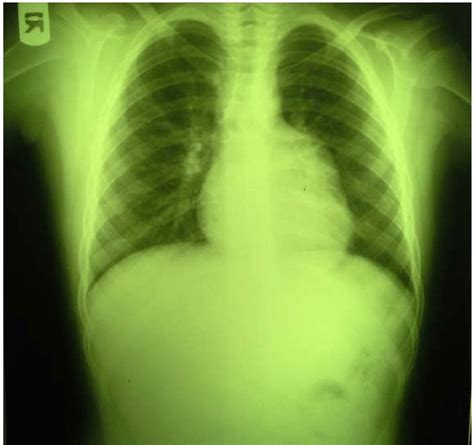 Chest X Ray Of The Patient Indicating Corrected Tof Download Scientific Diagram