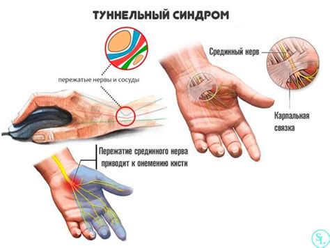 онемел средний палец на правой руке и не проходит что делать причины