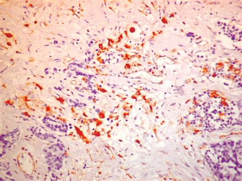 Appearance Of A Site Of Vimentin Expression In Tumor Cells A Sign Of