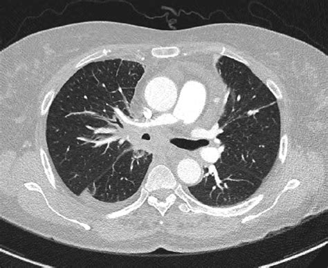 small residual amount of right pleural effusion with subsegmental