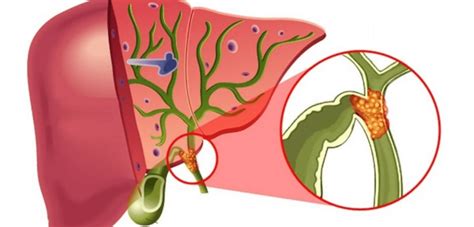 Gallbladder Inflammation