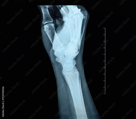 Lunate Dislocation X Ray Of The Side Of A Woman`s Hand And Wrist