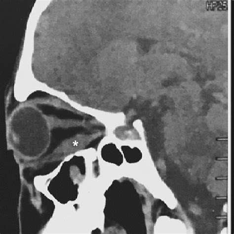 Orbital Mri T1 Scans Sagittal View A Diffuse Enlargement B