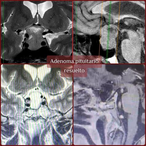 Adenomas De Hipófisis Síntomas Diagnóstico Y La Cirugía Que Puede