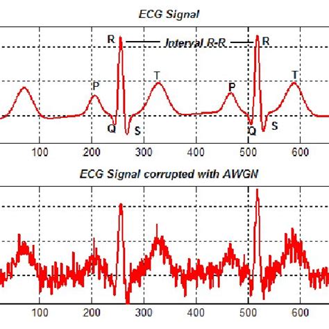 An ECG Signal Acquired Download Scientific Diagram