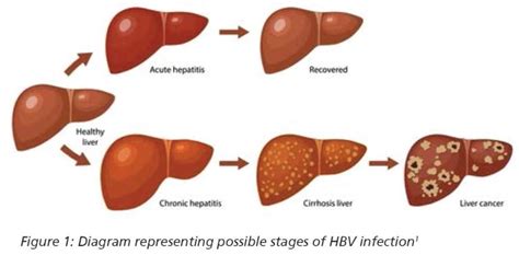 Chronic Hepatitis B Virus Hbv University Hospitals Sussex Nhs Foundation Trust