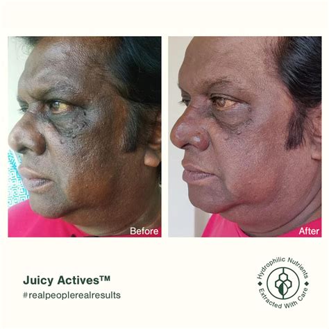 Hyperpigmentation And Scar Healing Kit Buddh Awaken To Ayurveda