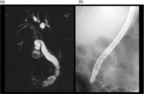 Peroral Digital Cholangioscopy‐assisted Removal Of A Migrated Biliary Plastic Stent Using A