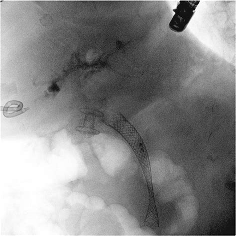 Fluoroscopy Image Showing Both Stents Transpapillary Drainage With A Download Scientific