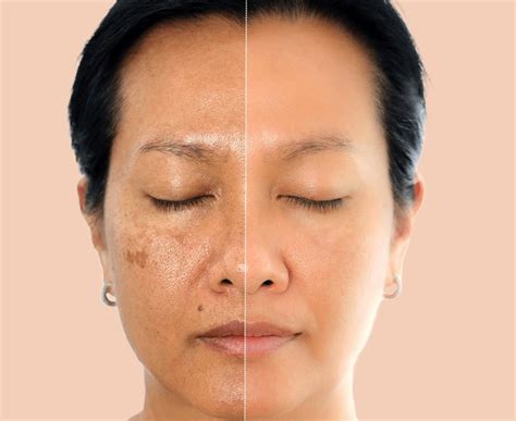 Dark Spot On Face