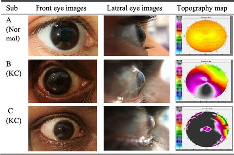 Table 2 From Keratoconus Detection Using The Fusion Features Of Anterior And Lateral Segment