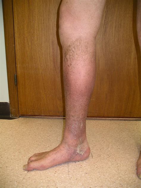 Chronic Leg Swelling Clinical Tree