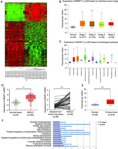 Expression Of Mesp1 In Nsclc Patients Was Based On Bioinformation Data