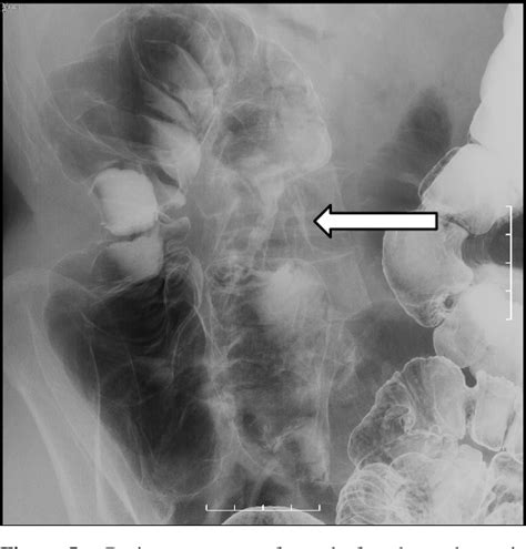 Figure From A Case Of Concomitant Small Bowel GIST And Colorectal Cancer Treated By