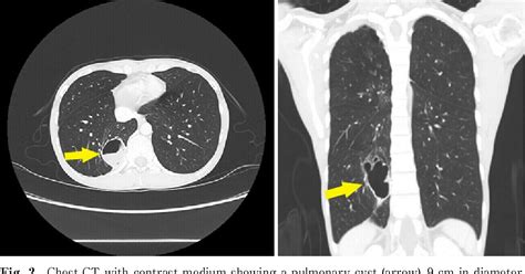 Figure 1 From Surgical Resection Of An Infectious Pulmonary Cyst In A