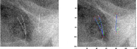 fiducial marker detection results on kv image at an oblique view