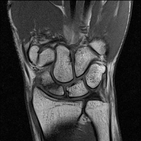Scaphoid Fracture Mri