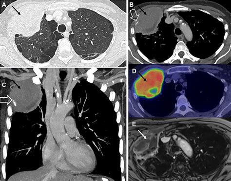 Figure 1 From Large Apical Lung Cancer Treated With Ct Guided Percutaneous Cryoablation