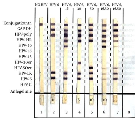Examples Of Hpv Results Obtained Using The Linear Array Hpv Genotyping Download Scientific