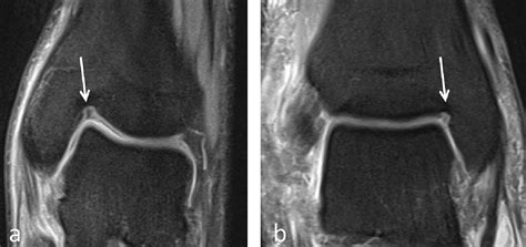 Mri Identification Of Pseudolesions In The Distal Tibia Articular Surface Frequency And