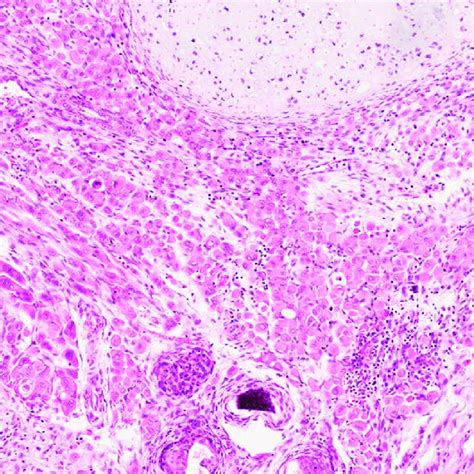 Preoperatively Treated Wilms Tumour With Prominent Skeletal Muscle