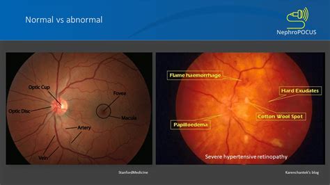 Hypertensive Retinopathy Vs Normal