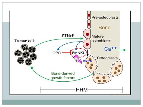 Hypercalcemia In Malignancy Pptx Endocrine And Metabolic Diseases