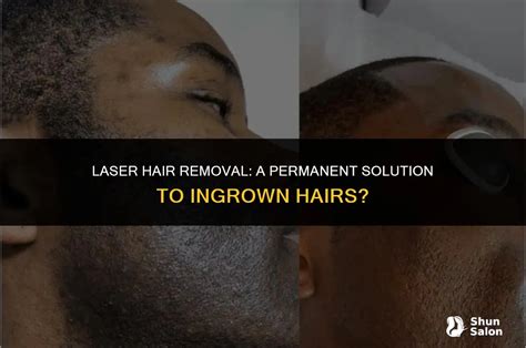 Laser Hair Removal A Permanent Solution To Ingrown Hairs Shunsalon