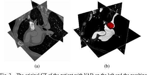 Figure 2 From Semi Automatic Three Dimensional Vessel Segmentation Using A Connected Component