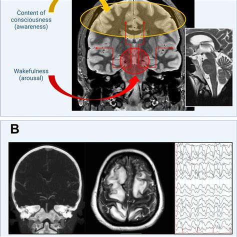 A Cortico Cortical Connectivity Involving Fronto Parietal Networks Is Download Scientific