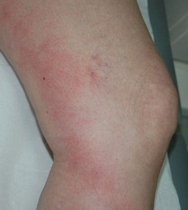 Superficial Venous Thrombosis Vein Clinic Perth