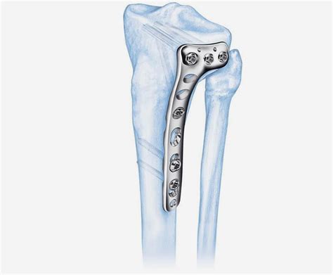 Proximal Tibia Plates Depuy Synthes