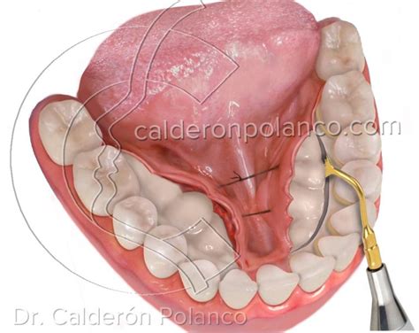 Dr Javier Calderón Polanco Torus Y Exóstosis