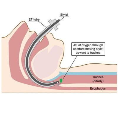 Endotracheal Tube Stylet Intubation Stylet Ideal Healthcare Sdn Bhd