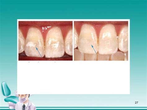 White Spot Lesion