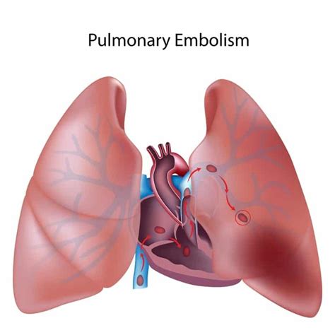 Sleep Apnea Can Contribute To Recurring Pulmonary Embolism Sleep Review