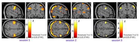 Patient S Female 28 Yo Activation In Primary Sensorimotor Cortex
