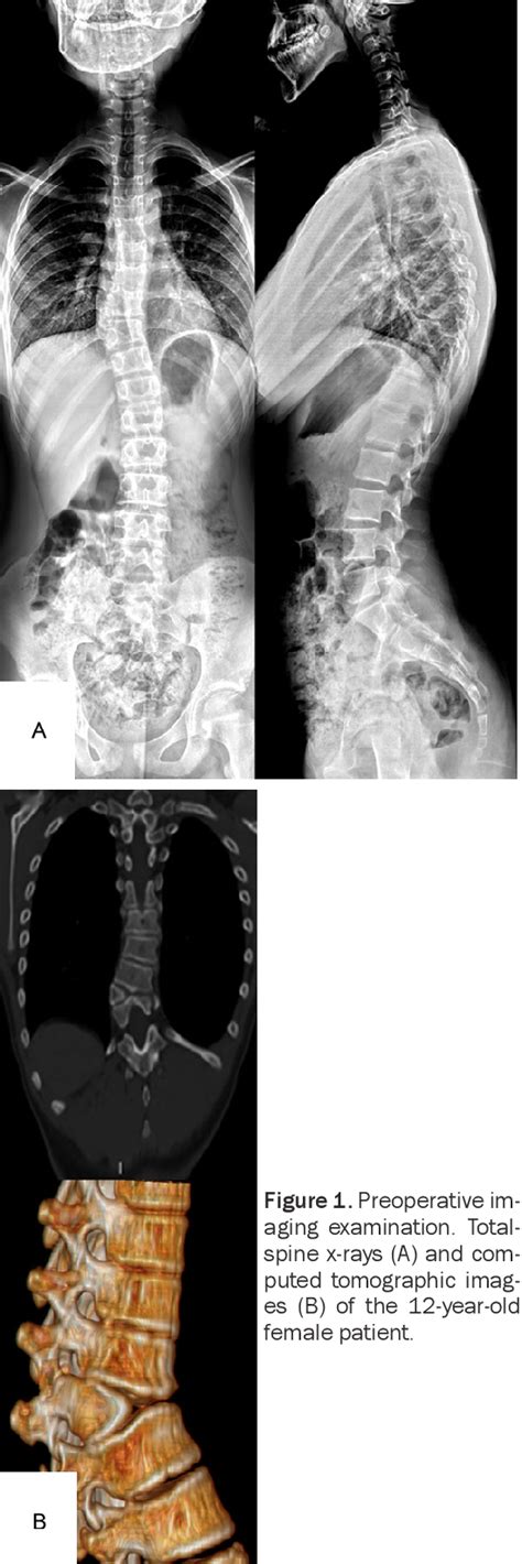 Figure 2 From Posterior Hemivertebra Resection With A Navigated