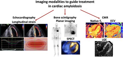 Monitoring Cardiac Amyloidosis With Multimodality Imaging Revista