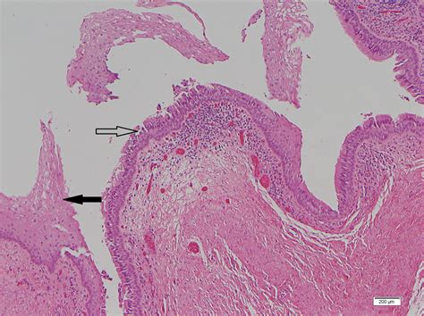 Prevalence Of Thyroid Gland Tissue In Midline Neck Dermoid Cysts In